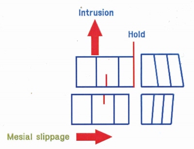 부정교합의 교합고경(Wedging effect) : 문제점과 해법 - 치학신문